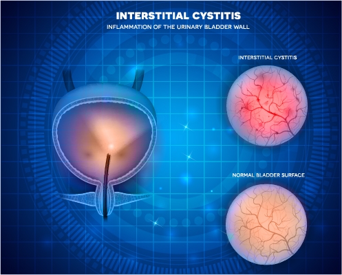 What is Interstitial Cystitis?